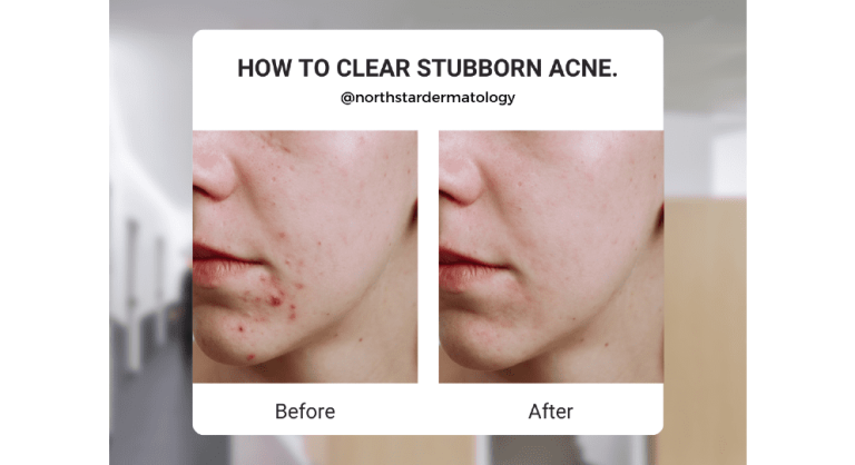 The Right Way To Clear Acne - Northstar Dermatology